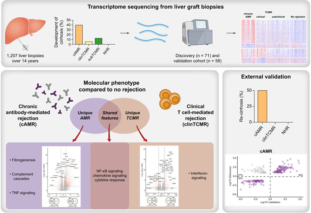 Pattern of chronic rejection for liver transplants decoded