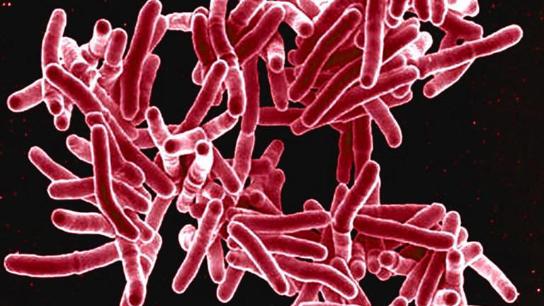 Tulare County tuberculosis cases on the rise. Here's what to know