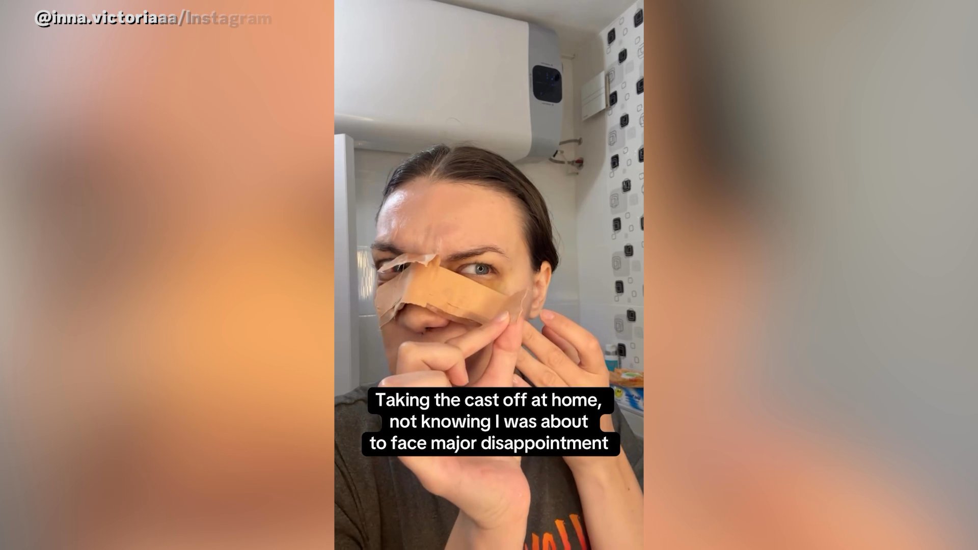 Woman Has Rhinoplasty, What She Notices 1 Week Later Goes Viral