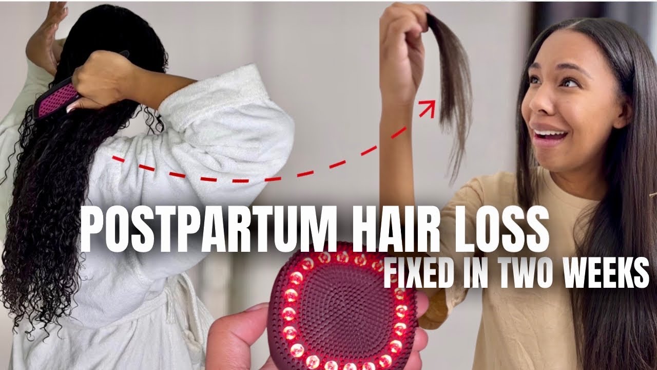 How I regrew my hair fast after postpartum and genetic hair loss ...