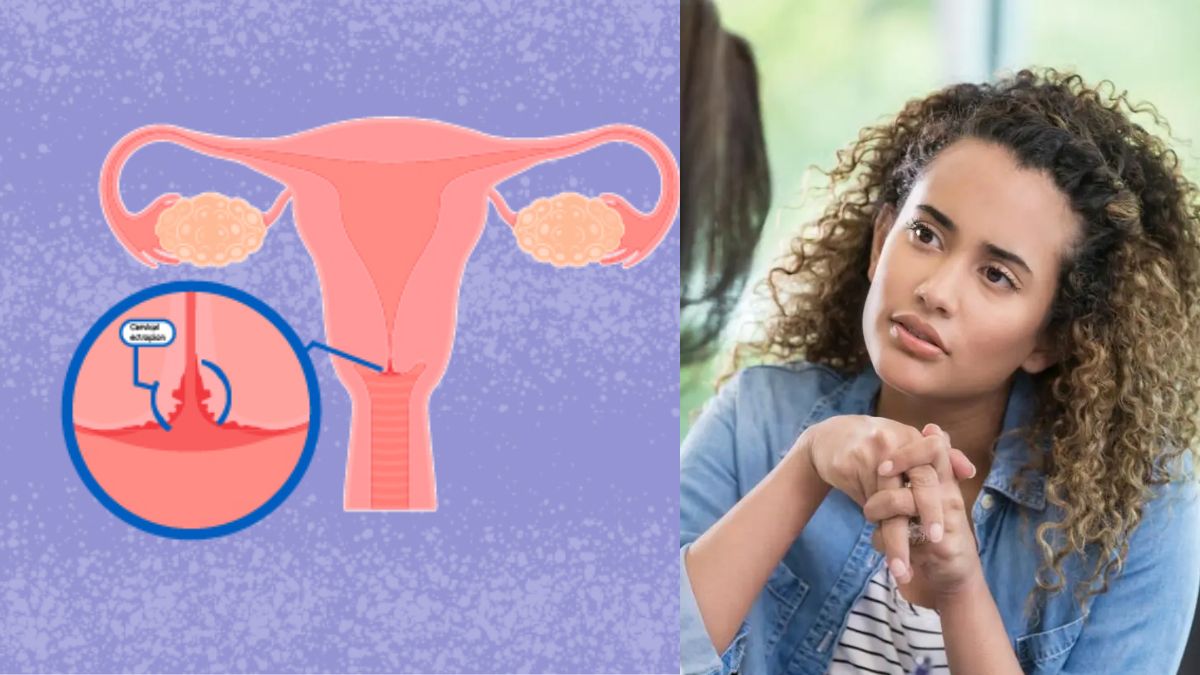 Cervical Ectopy vs Cervical Erosion: Expert Explains What This Common ...