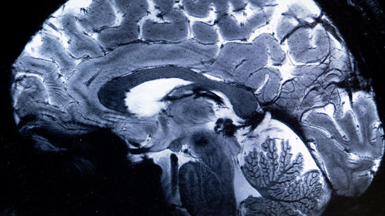 Brain Study Reveals Adolescence Lasts Until Shockingly Late in Life