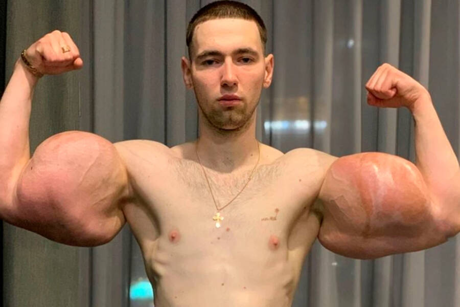 Bodybuilder russo devastato dalle iniezioni, braccia in necrosi, ora ...