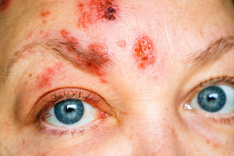 Treating shingles on the face