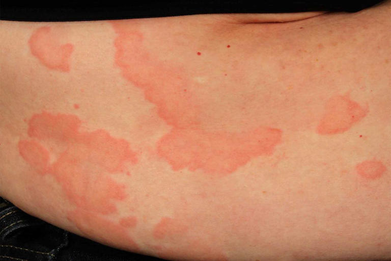 Why you have hives on your stomach and how to ease the itch