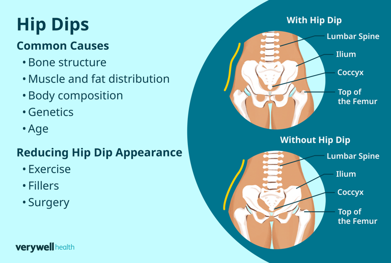 Hip Dips and What You Can Do About Them