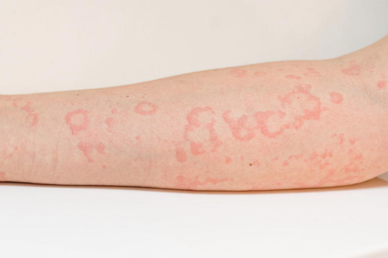 Pictures of Hives (Urticaria) to Help Identify a Skin Rash