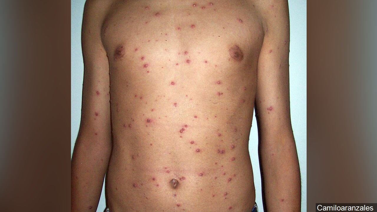 Buncombe County officials report increase in chickenpox, whooping cough ...