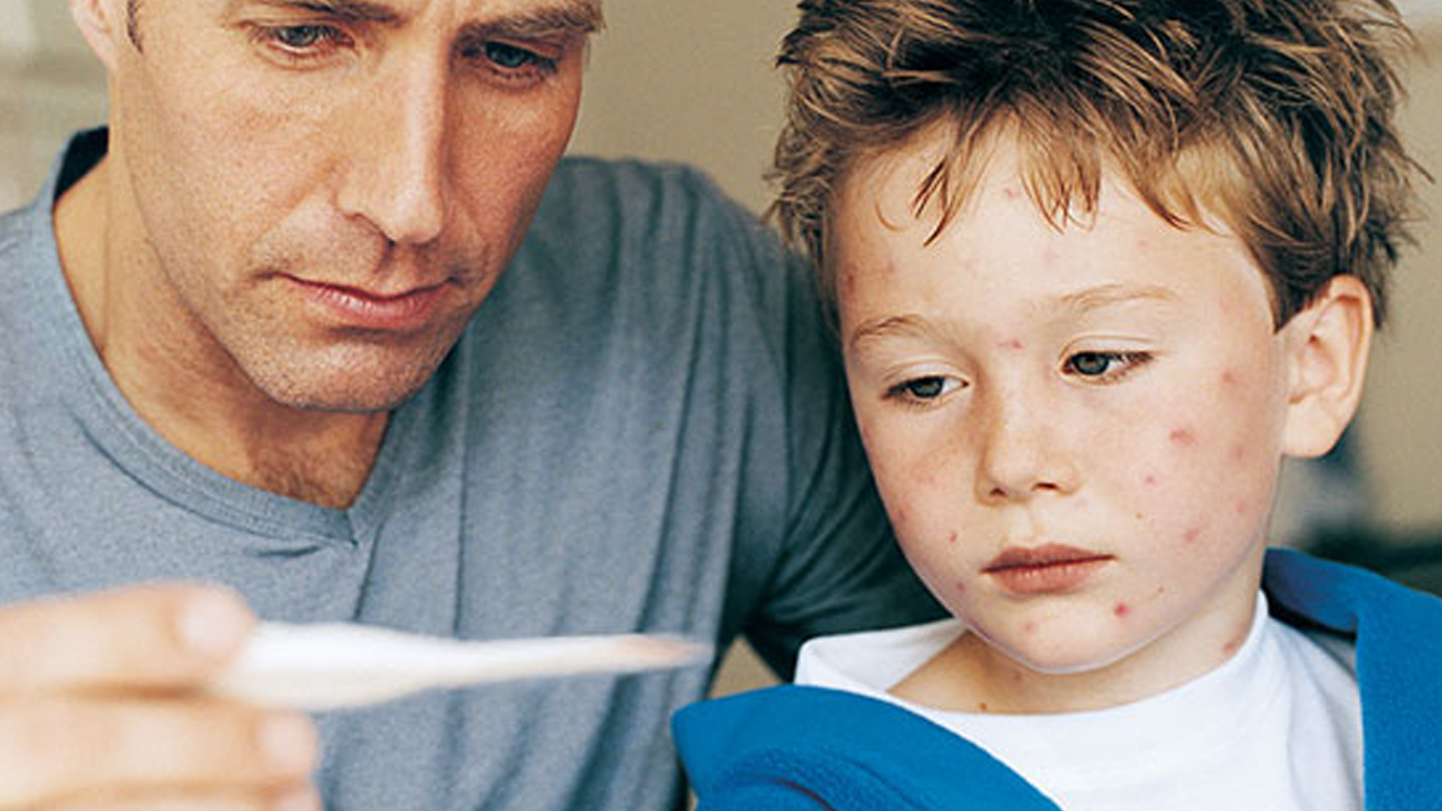 Buncombe County officials urge vaccination after uptick in chickenpox cases