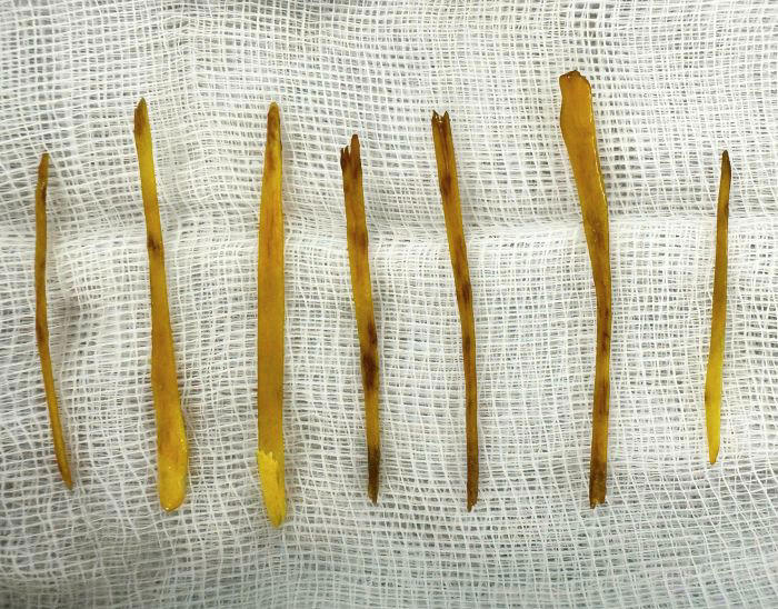 Cảnh giác nuốt dị vật ở trẻ, nguy cơ biến chứng cao nếu chậm xử lý