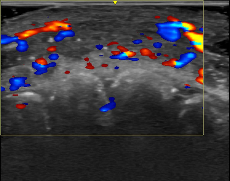 Ultrasound pinpoints vascular complications from cosmetic fillers