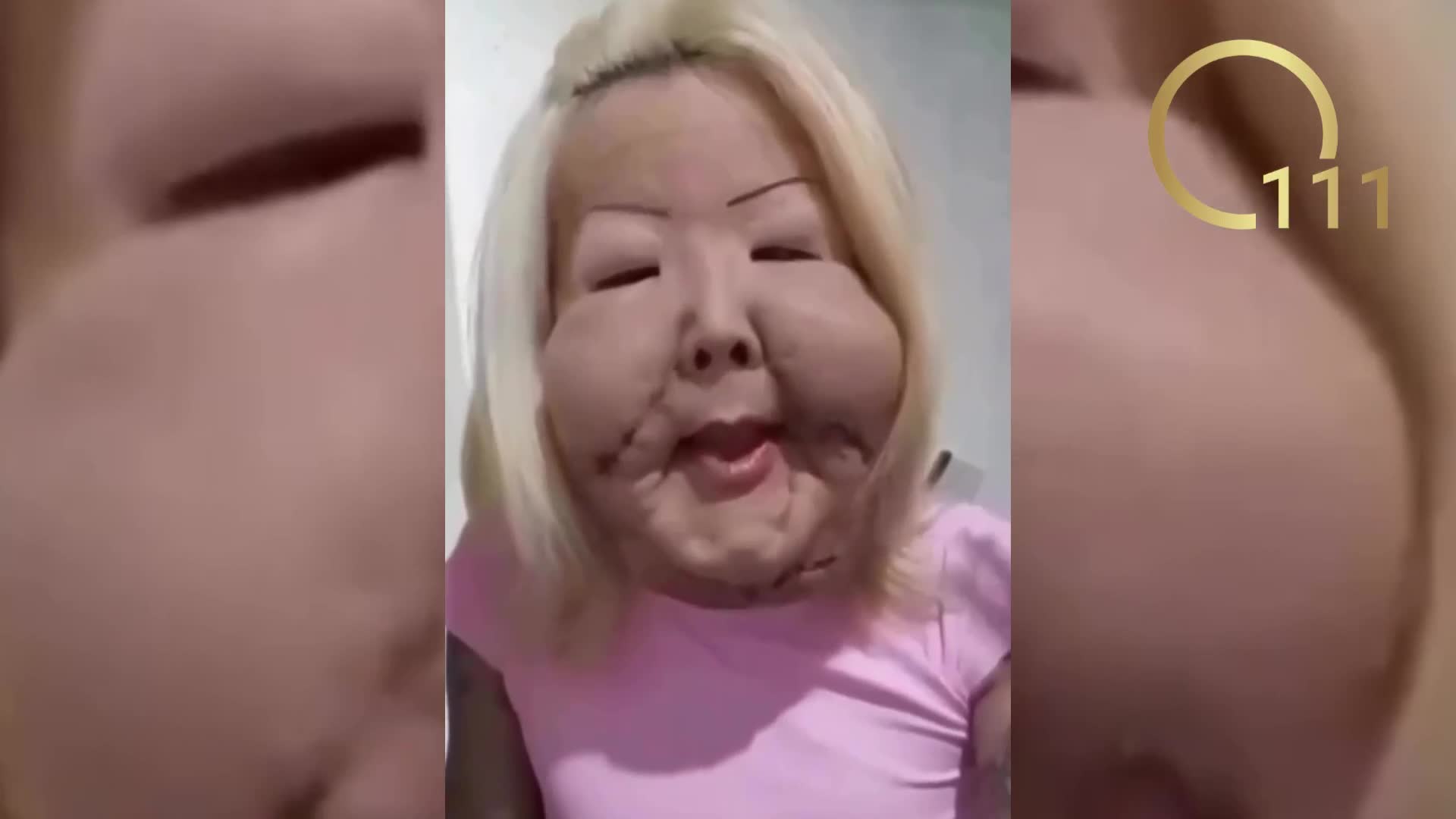 Após cirurgia reconstrutiva, Juju do Pix revela novo rosto e agradece apoio