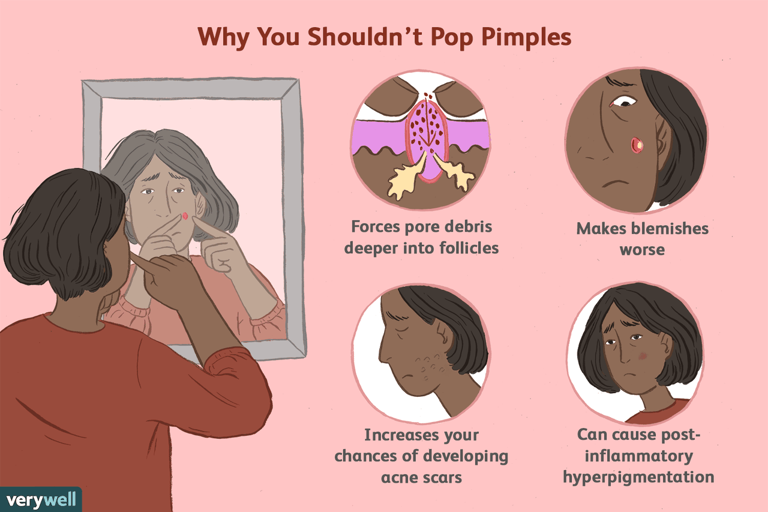 Is Popping Pimples Bad for Your Skin?
