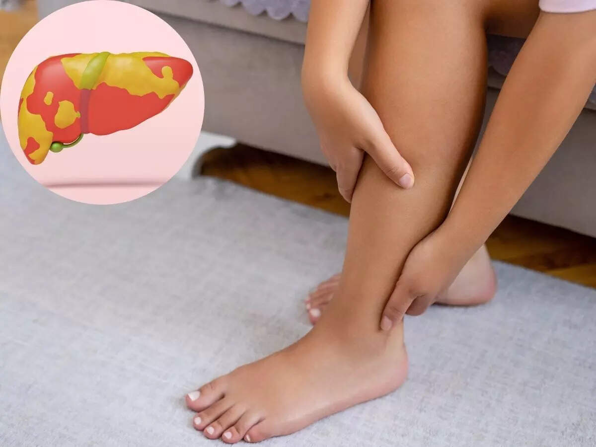Early fatty liver symptom could appear in legs. Gastro doctor explains ...