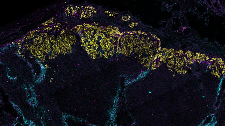 Breast cancer remodels lymphatic vessels to accelerate its spread ...