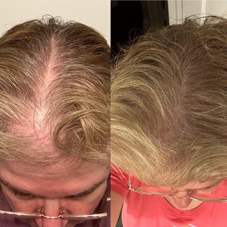 Fans swear these at-home gadgets can make your hair grow — but do they really work?