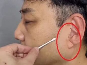 Surgeon debunks earlobe crease heart attack theory
