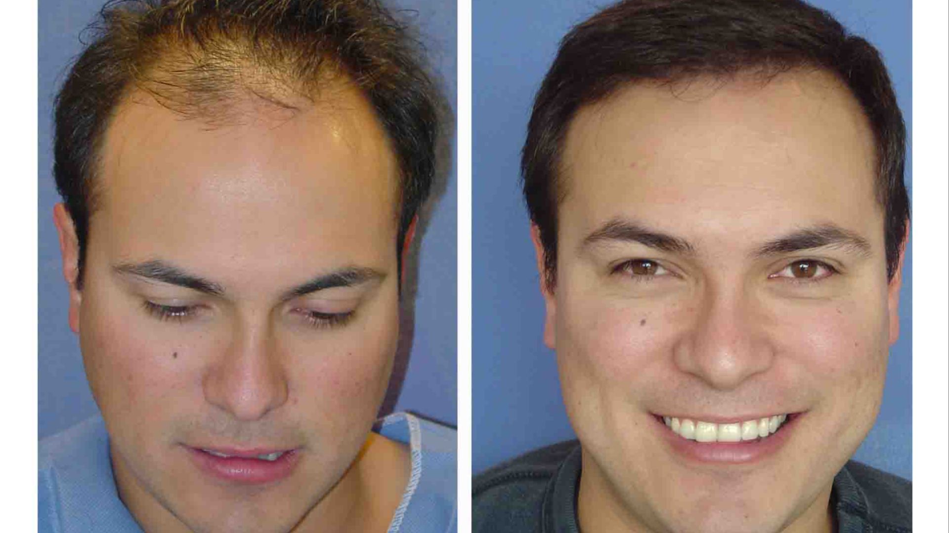 Hair Transplants Are More Popular Than Ever. Here's Why You Should ...