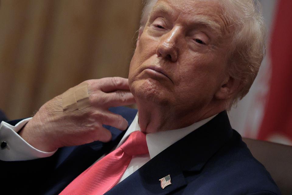 Trump seen with bandaged right hand again: Here’s what we know