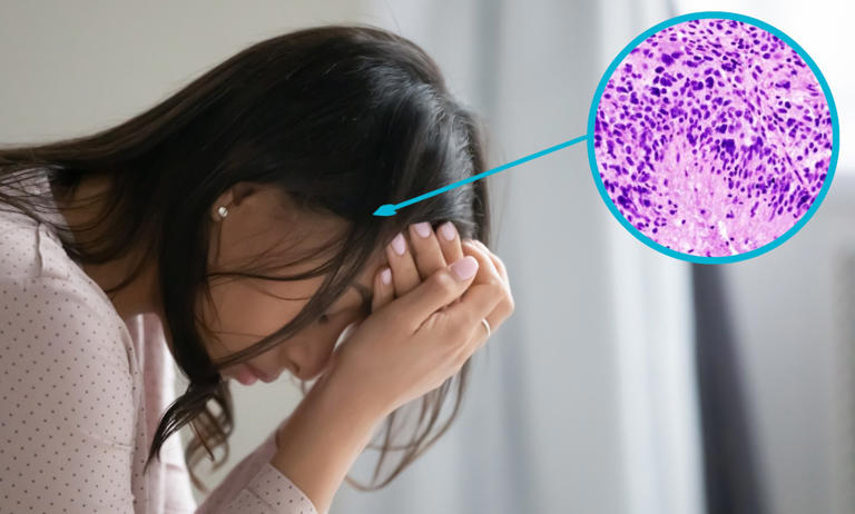 Stary lek ciążowy otwiera drzwi do nowych terapii raka mózgu