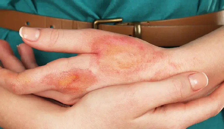 8 effective home remedies to treat burnt skin marks