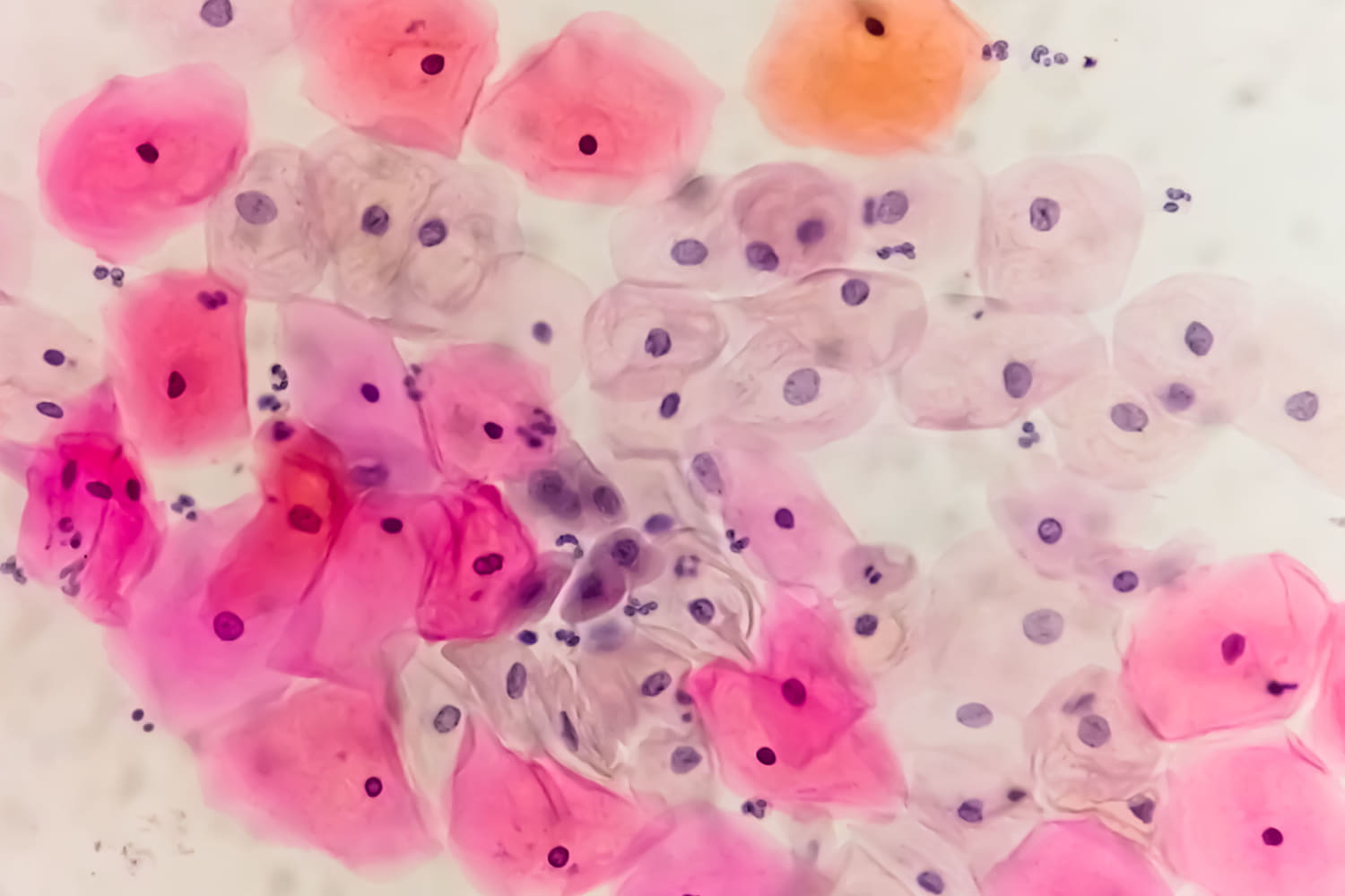 American Cancer Society recommends self-swab HPV test for cervical ...