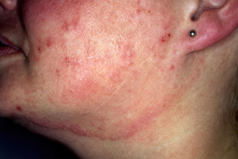 7 at-home treatments to clear ringworm quickly