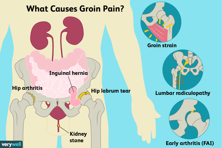 Groin pain: Causes and how to get rid of it