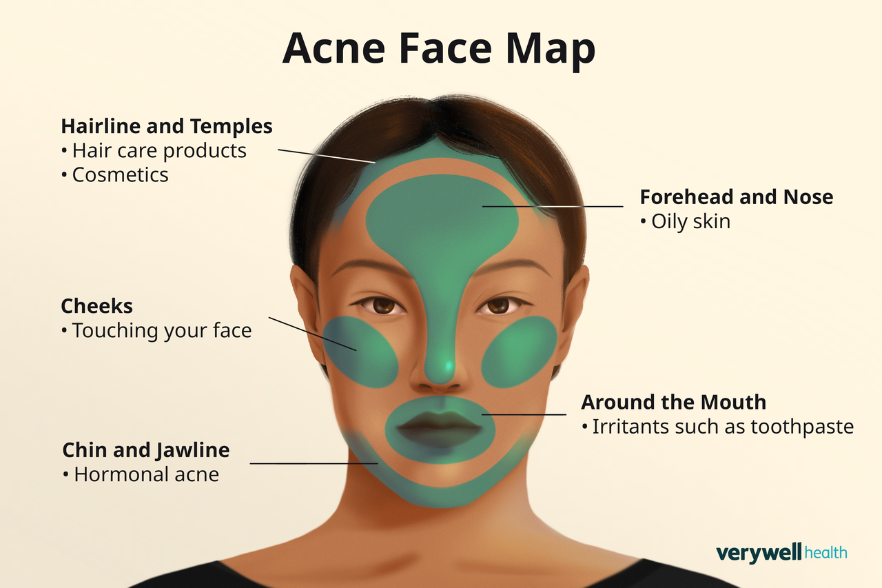 Acne face map: How to identify causes of your breakouts