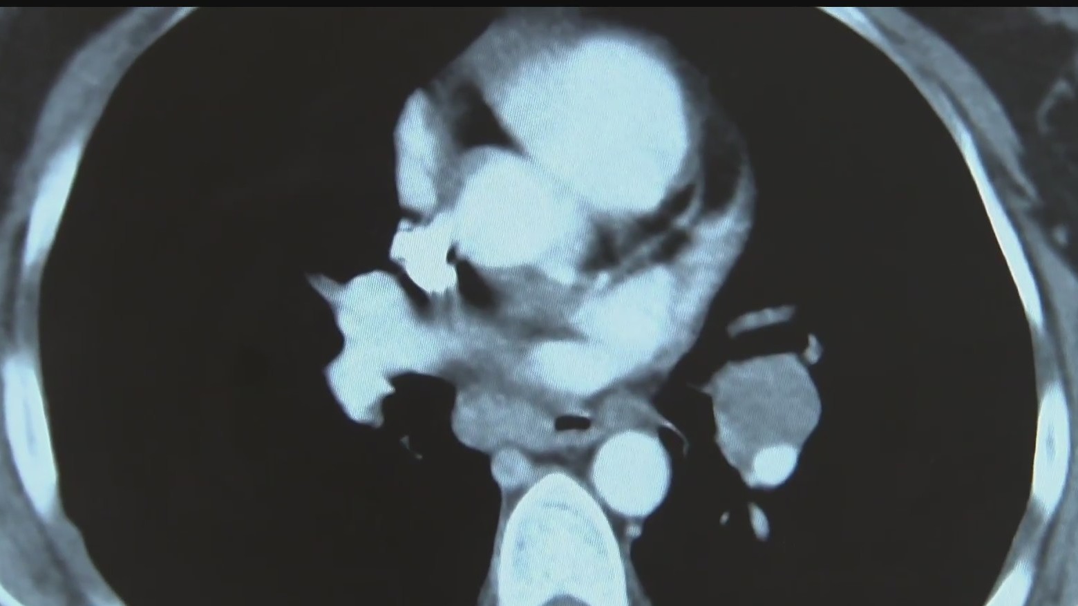 ACS updates cervical cancer screening: self-collection approved ...
