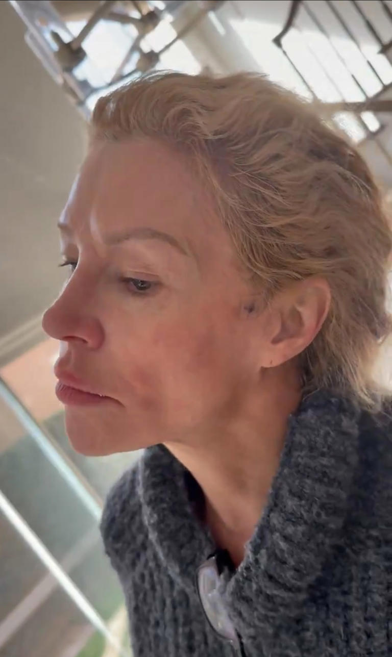 Thrilled Brandi Glanville says she finally received diagnosis for face ...