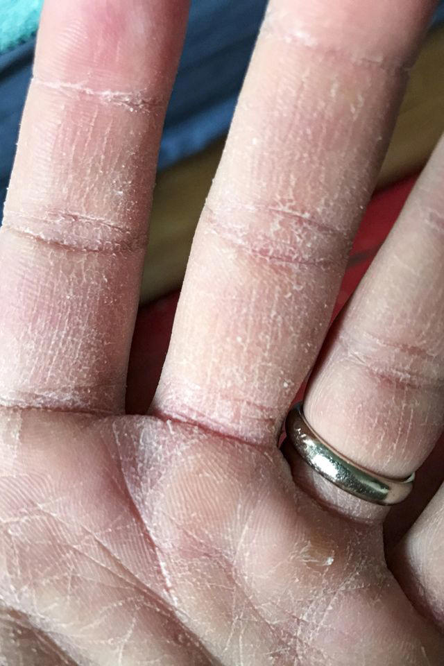 9 triggers behind a rash on palms and how to treat each