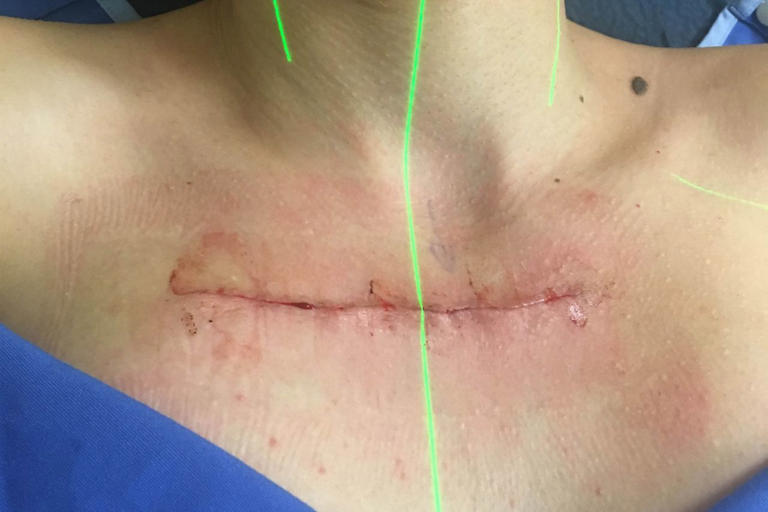 The stages of wound healing: A timeline of the process