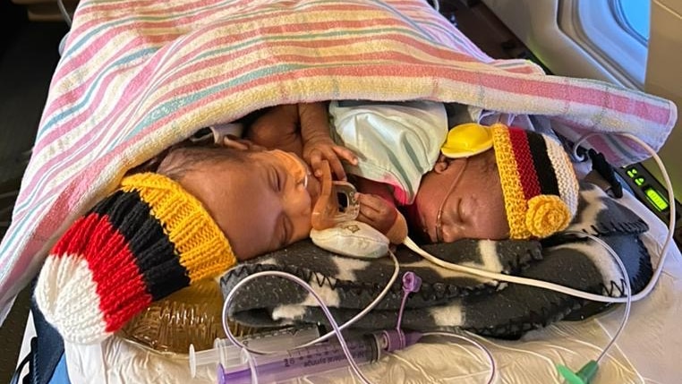 One of PNG's rare conjoined twins dies after urgent surgery in Sydney ...