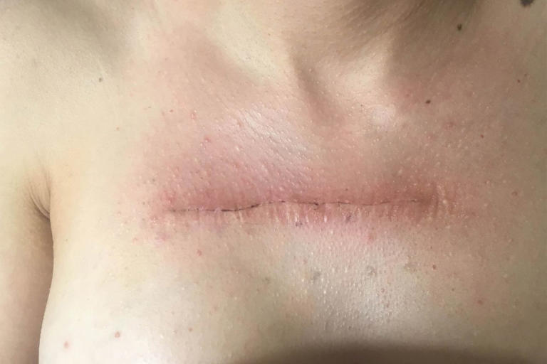 The stages of wound healing: A timeline of the process