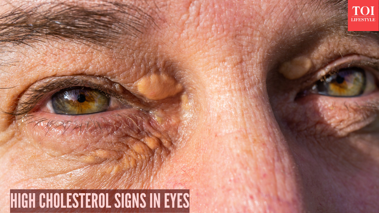 High cholesterol in the eyes: 5 warning signs you need to look out for