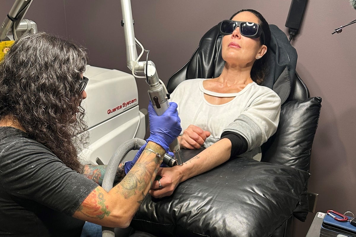 What it’s really like to have a tattoo burnt off you – and the cost