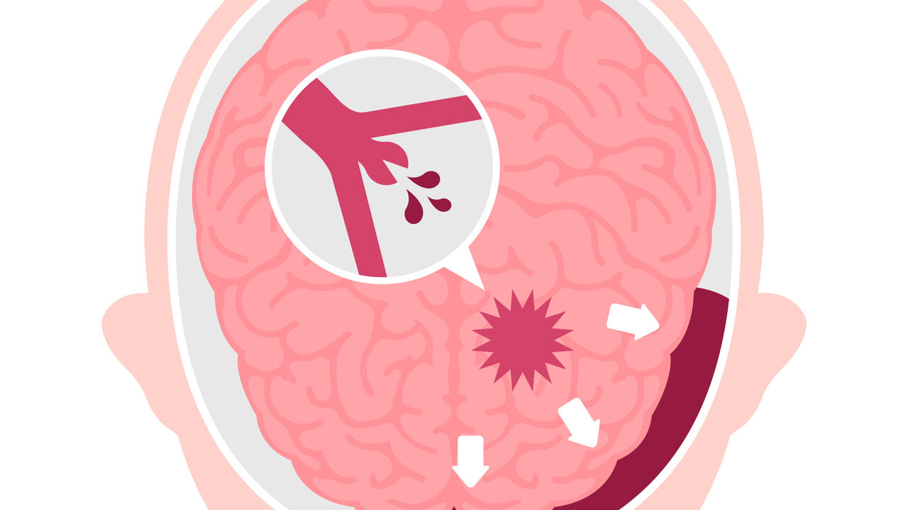 "Hoge bloeddruk is belangrijkste factor": hoe herken je een ...