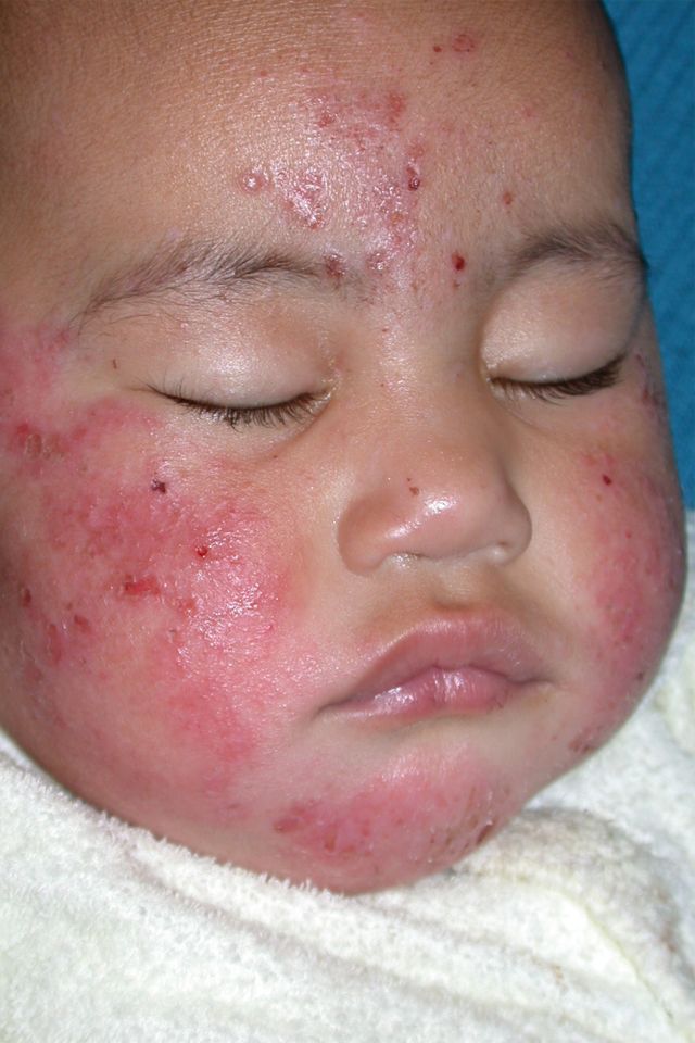 How to recognize and treat an allergic reaction in babies and infants