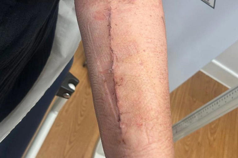 'I thought I had pulled a muscle in my arm - true diagnosis shattered me'