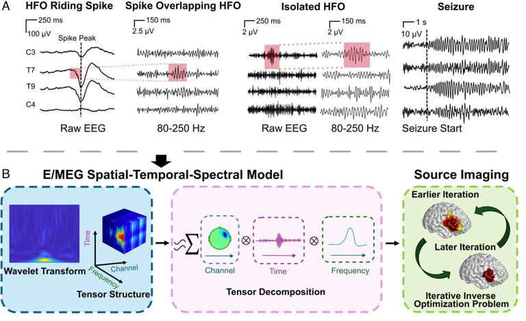 Unified EEG imaging improves mapping for epilepsy surgery