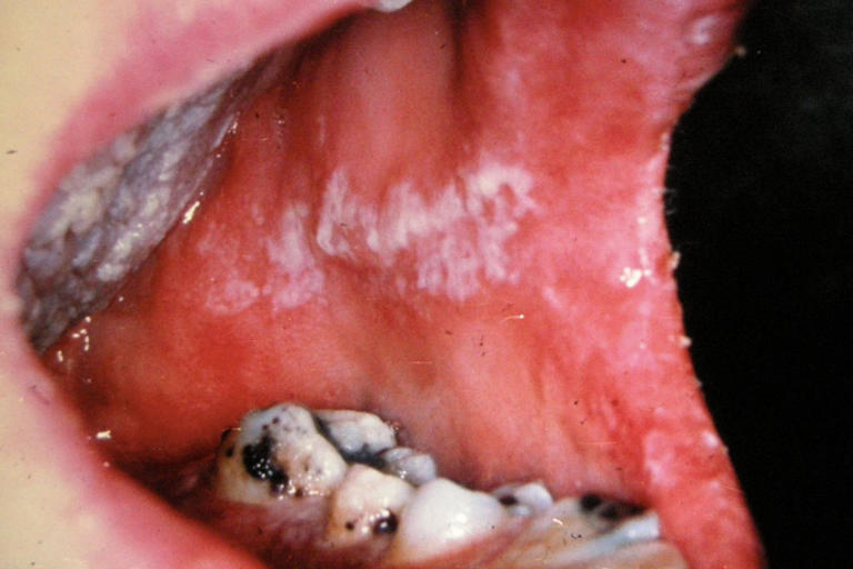 12 home remedies for oral thrush