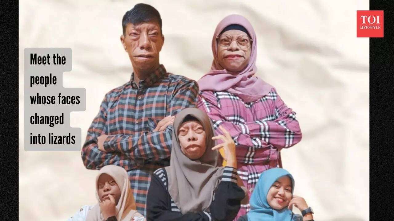 Lizard people: The people whose faces transformed over the years-- and ...