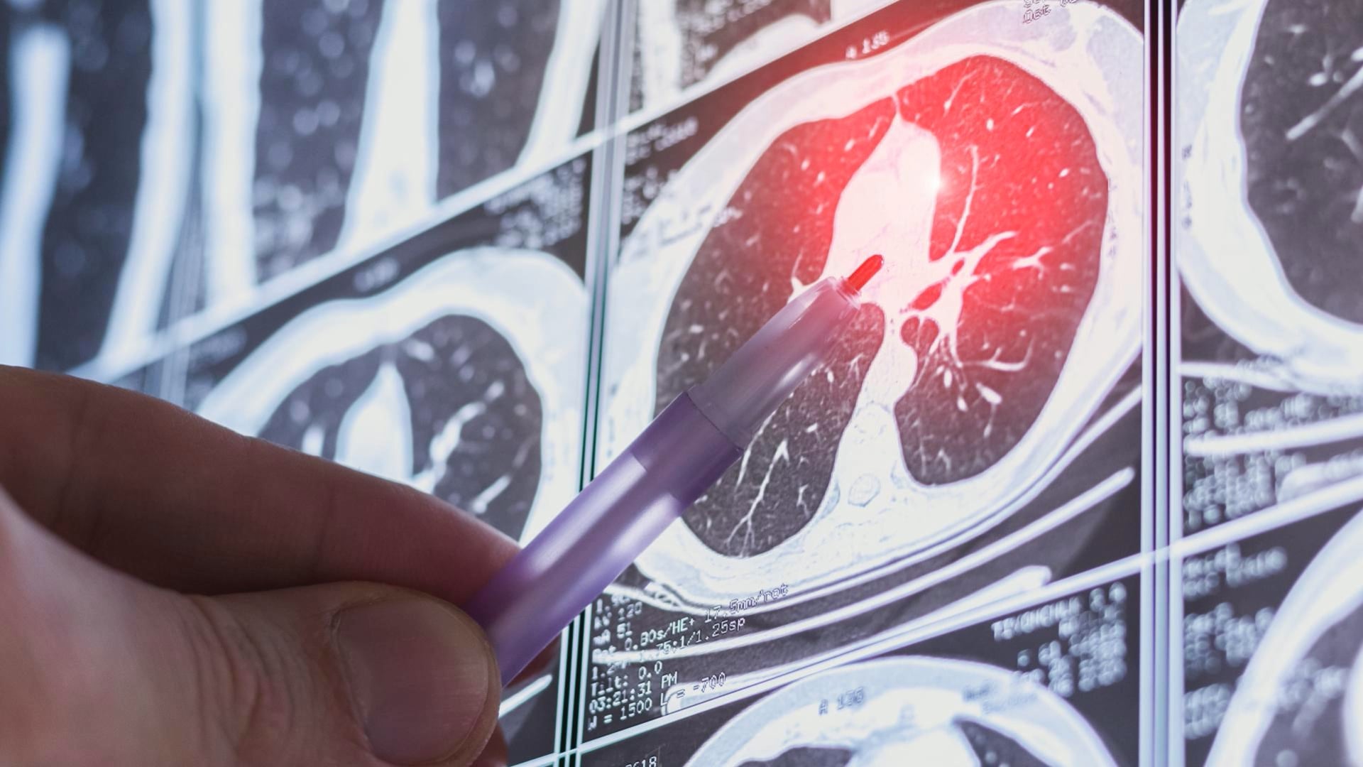 Comment Détecter Les Premiers Signes Du Cancer Du Poumon