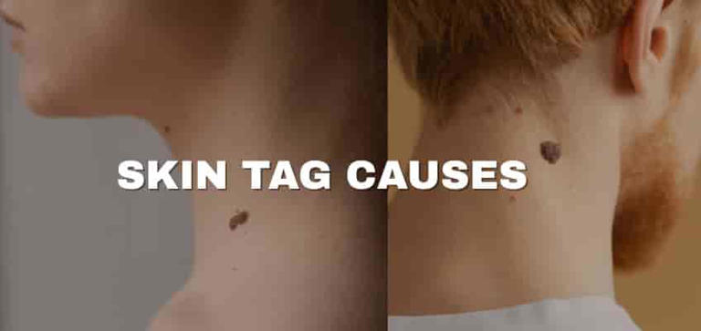 Skin Tag Causes: What Triggers Them And How You Can Stop New Ones from ...