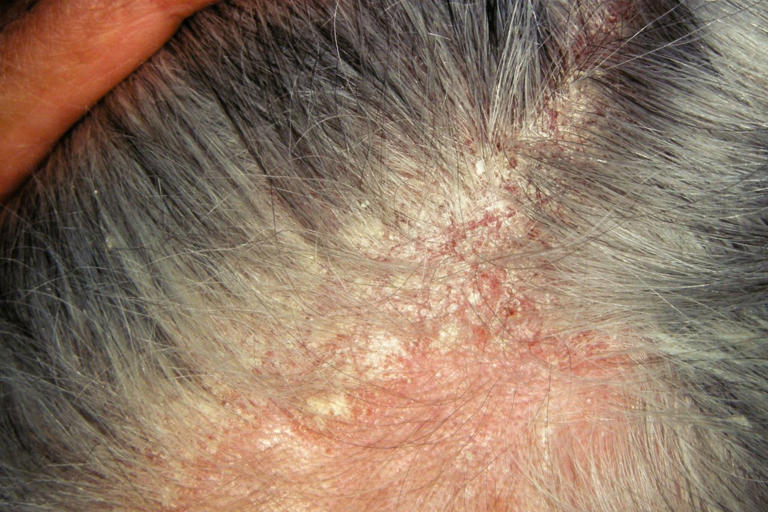 Causes of red spots on your scalp and how to treat them