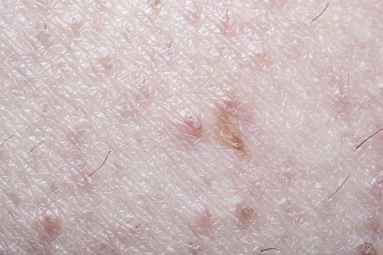 How to treat an ingrown hair cyst