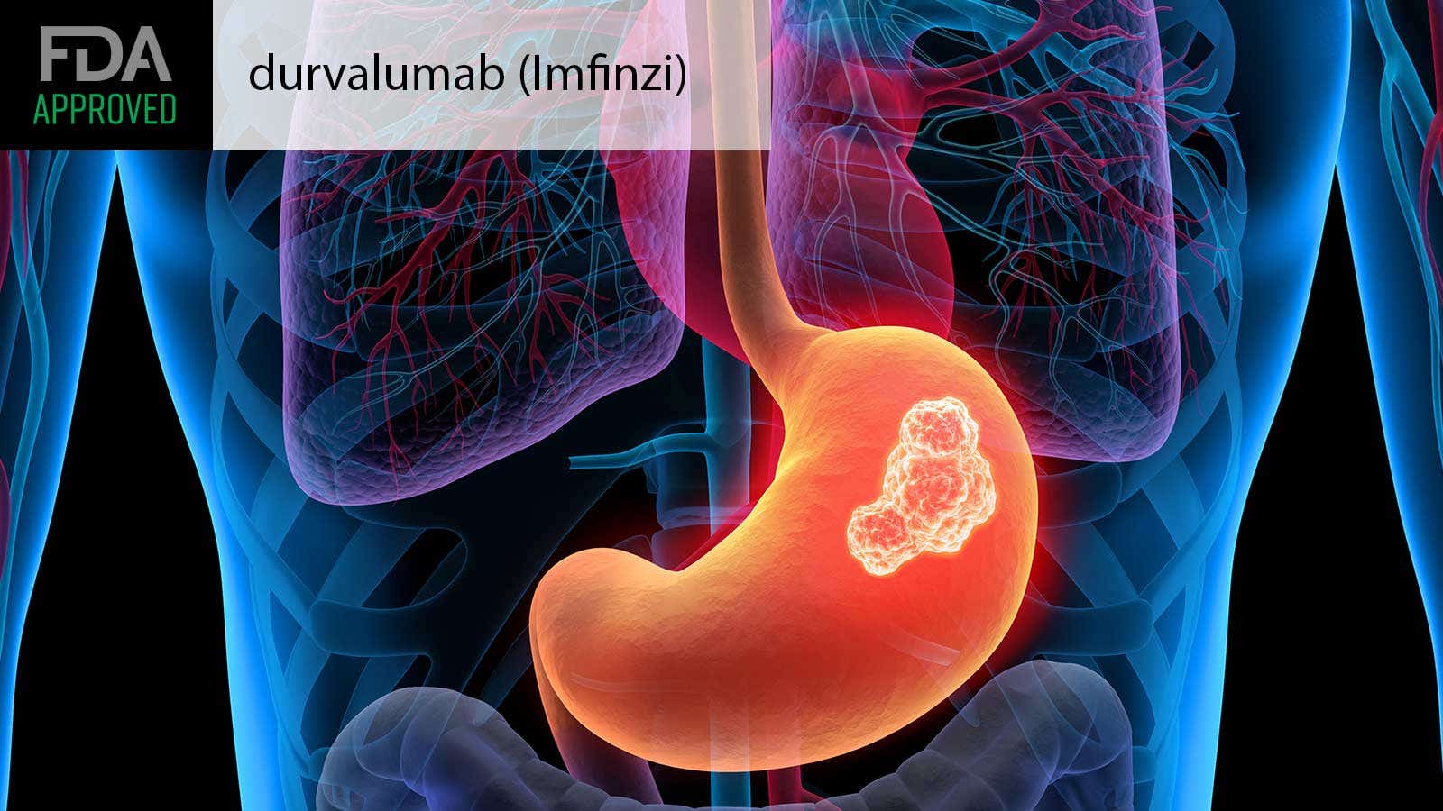 FDA OKs Perioperative Immunotherapy for Stomach Cancer