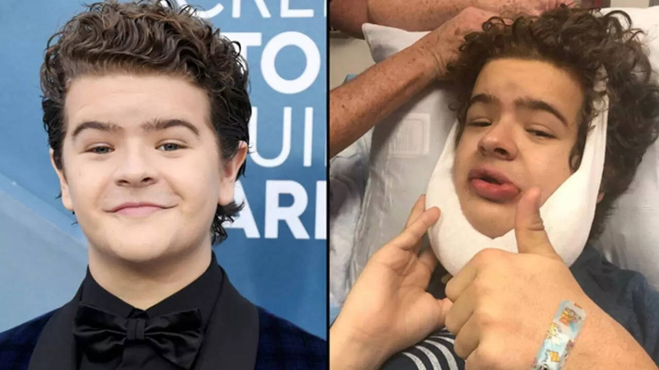 Stranger Things’ Dustin suffers from cleidocranial dysplasia (CCD) in ...