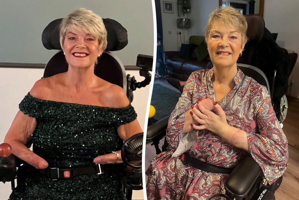 Quadruple amputee reveals she is now left-handed after undergoing ...
